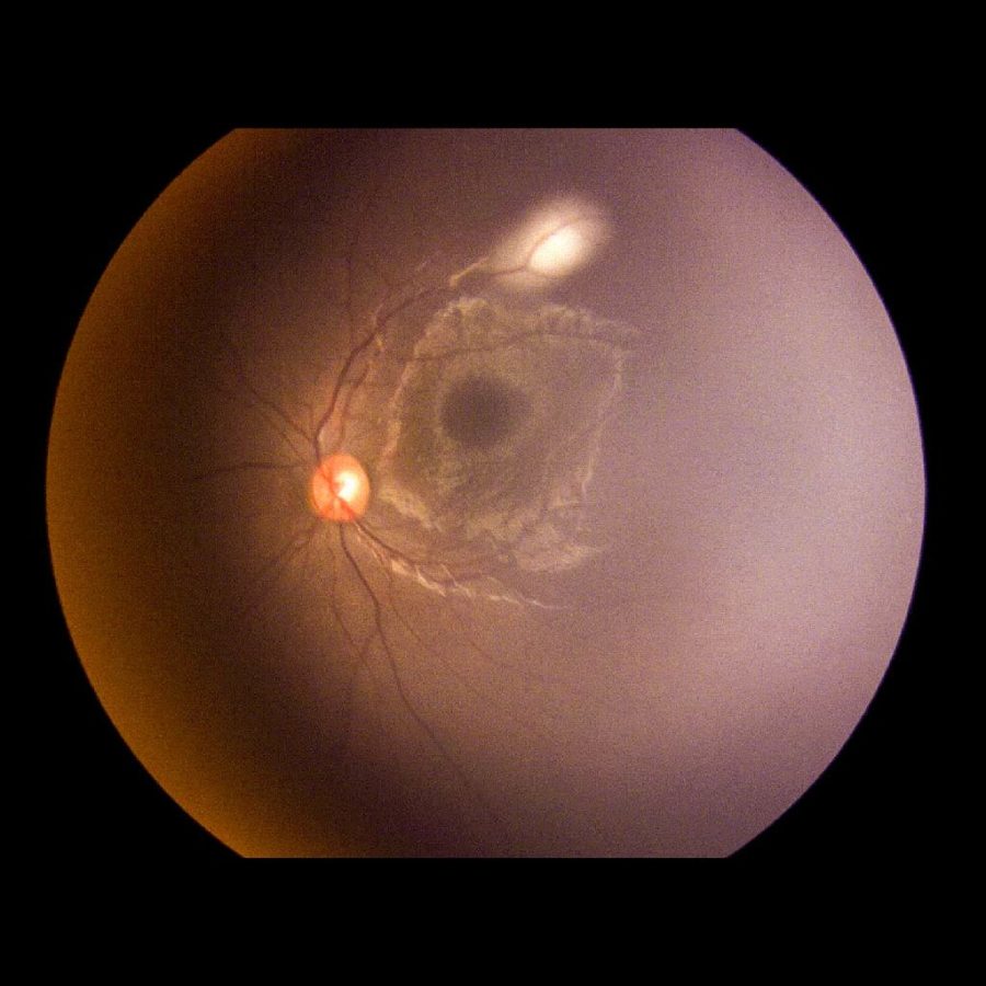Tumores Intraoculares – Oncología Ocular